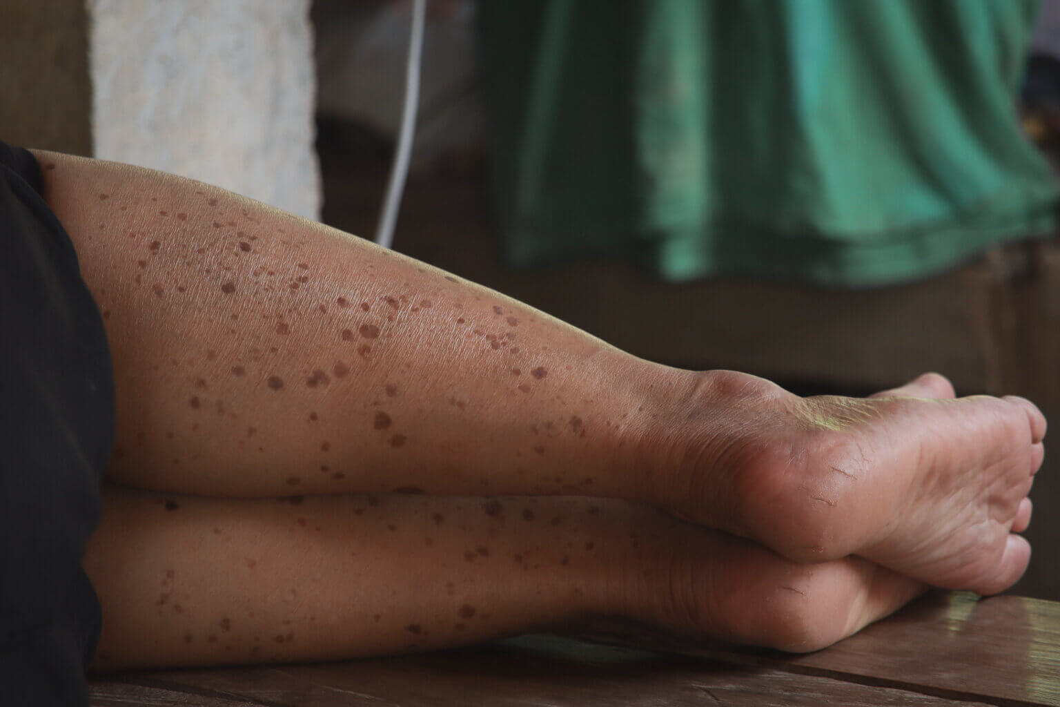 Was Sie über Sommersprossen und Pigmentflecken wissen sollten - apotheken welt