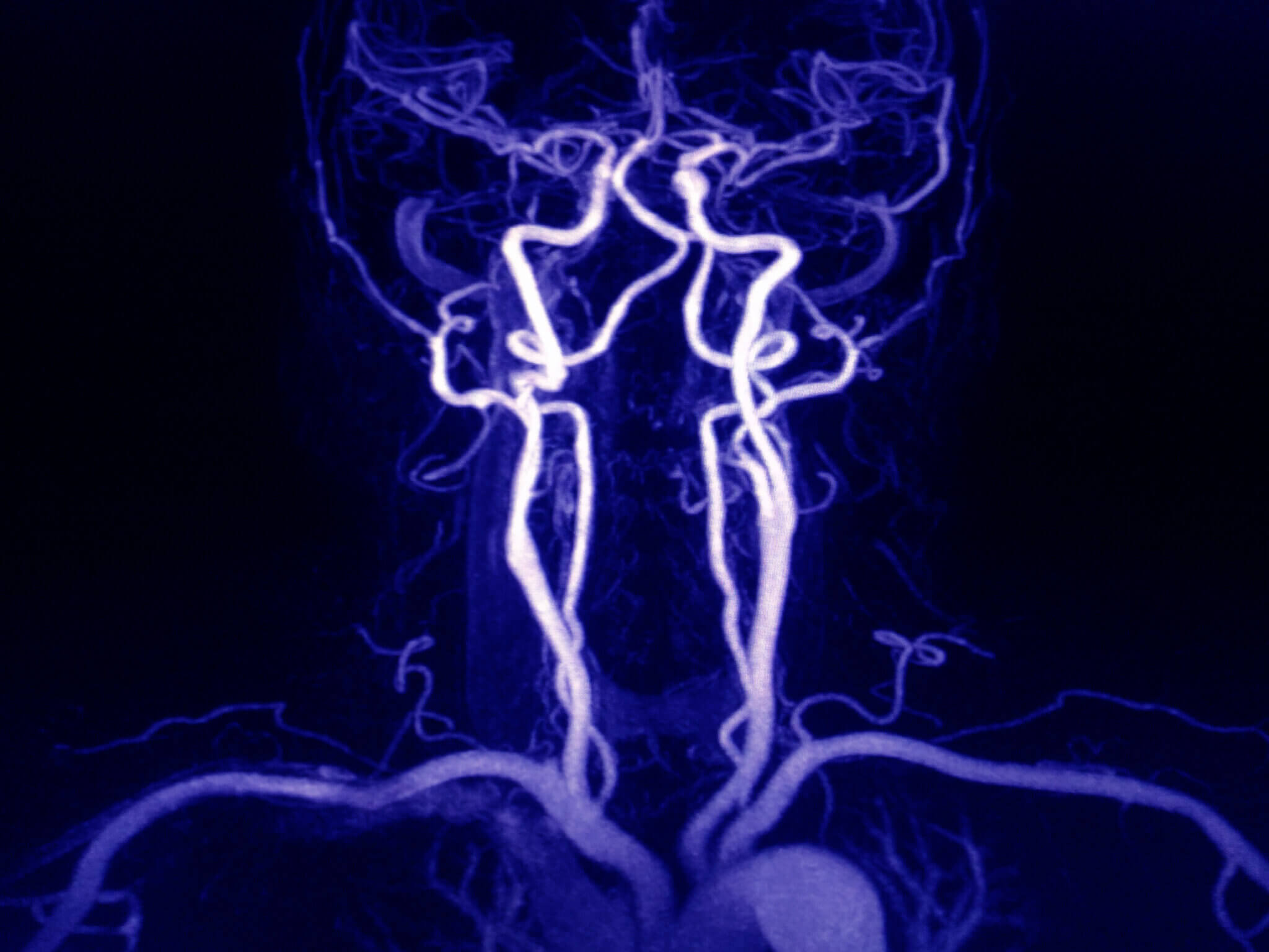 Orthopnoe bei Herzinsuffizienz - Zusammenhänge, Symptome und Behandlung ...